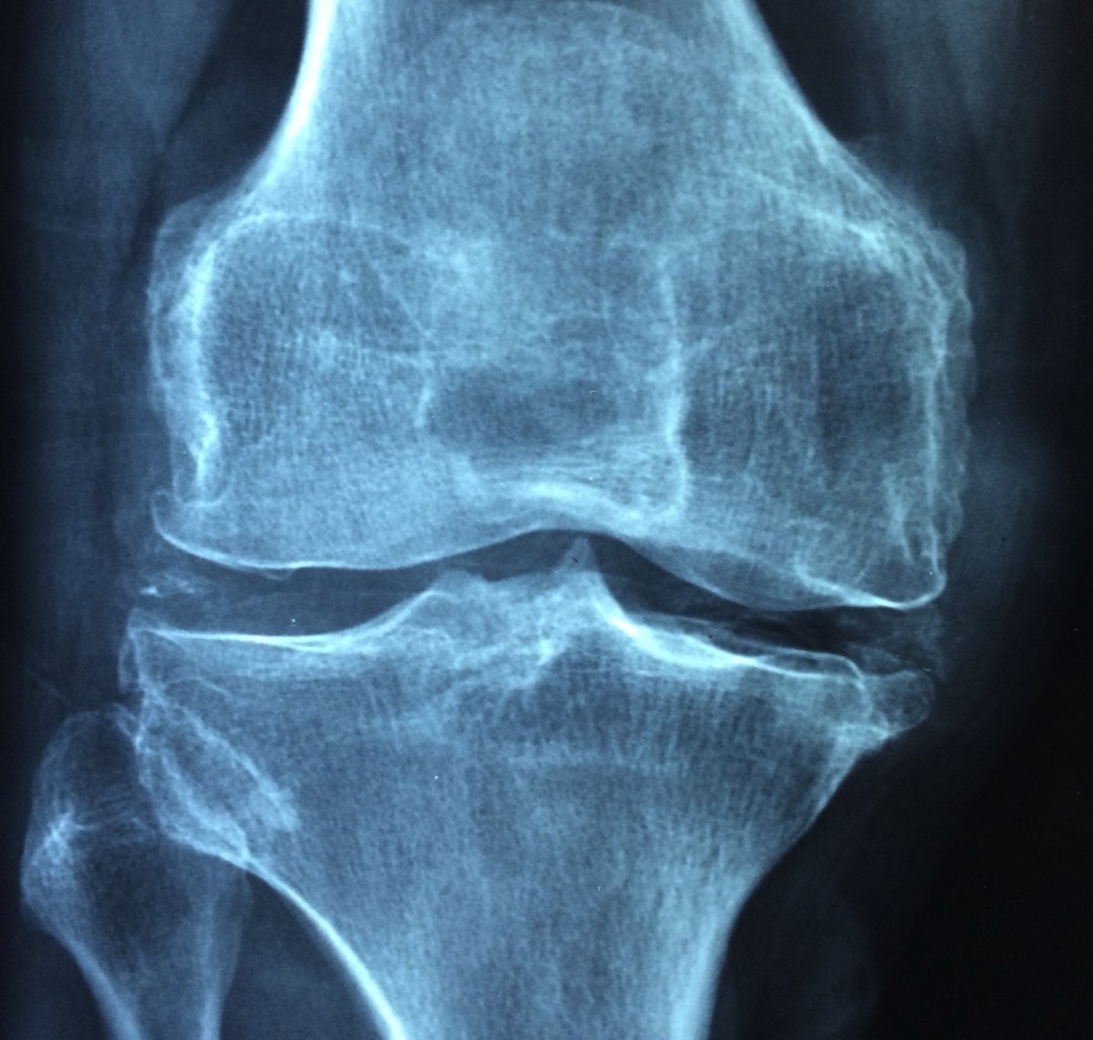 Maladie de Verneuil | Vaincre Verneuil